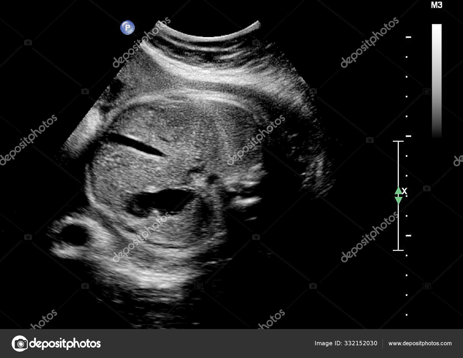 Ultrassom do feto no terceiro mês de gravidez — Foto © jovannig #332152030