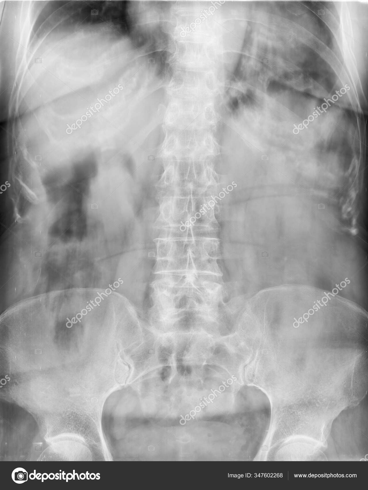 Radiographie Lombo Sacrée Colonne Vertébrale Bassin Analyse L'examen ...