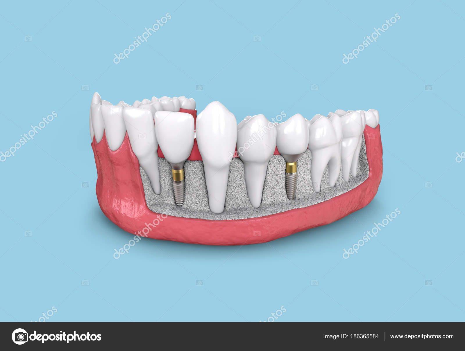 Tooth implant model in jaw 3d illustration Stock Photo by ©urfingus ...