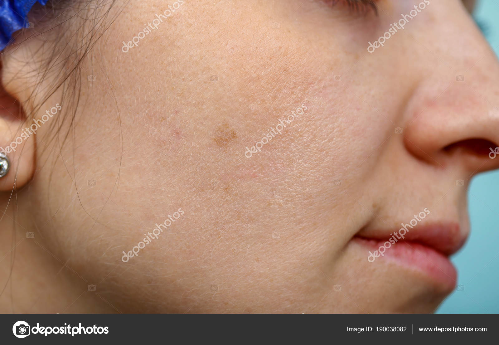 Пигментация кожи . стоковое фото ©nikolasvn 190038082