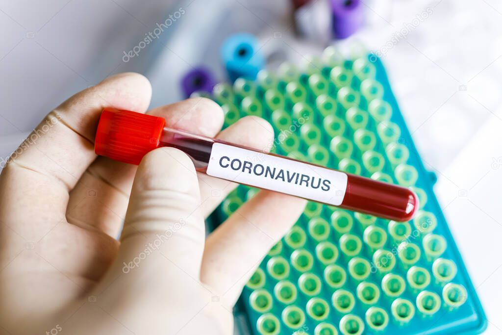 Tubo de ensayo COVID-19 y muestra de laboratorio de análisis de sangre ...