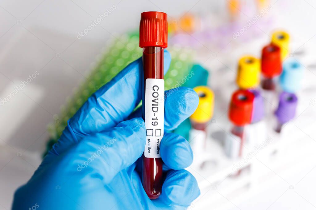 Tubo de ensayo COVID-19 y muestra de laboratorio de análisis de sangre ...