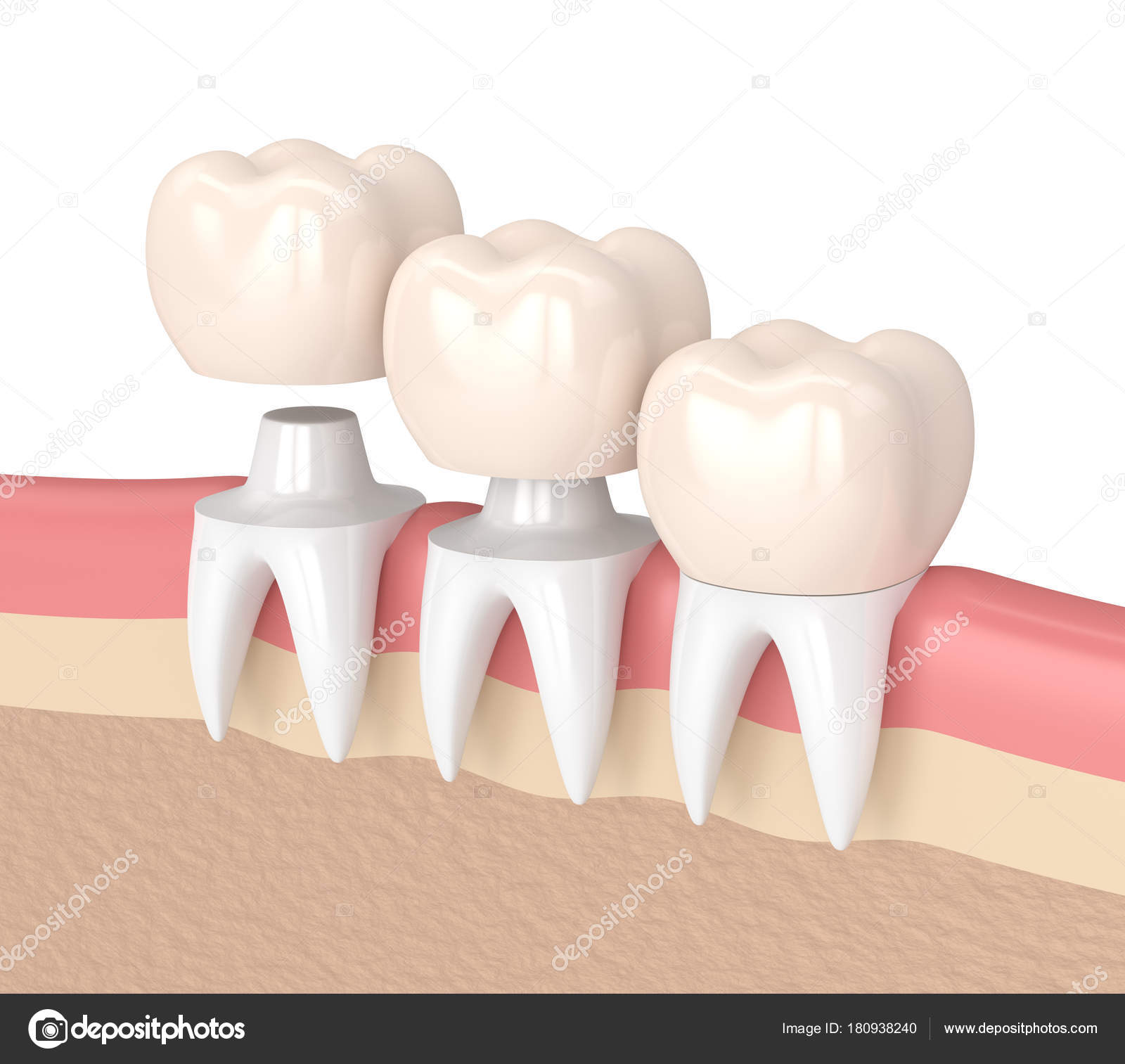 3d render of replacement crowns cemented onto reshaped teeth Stock ...