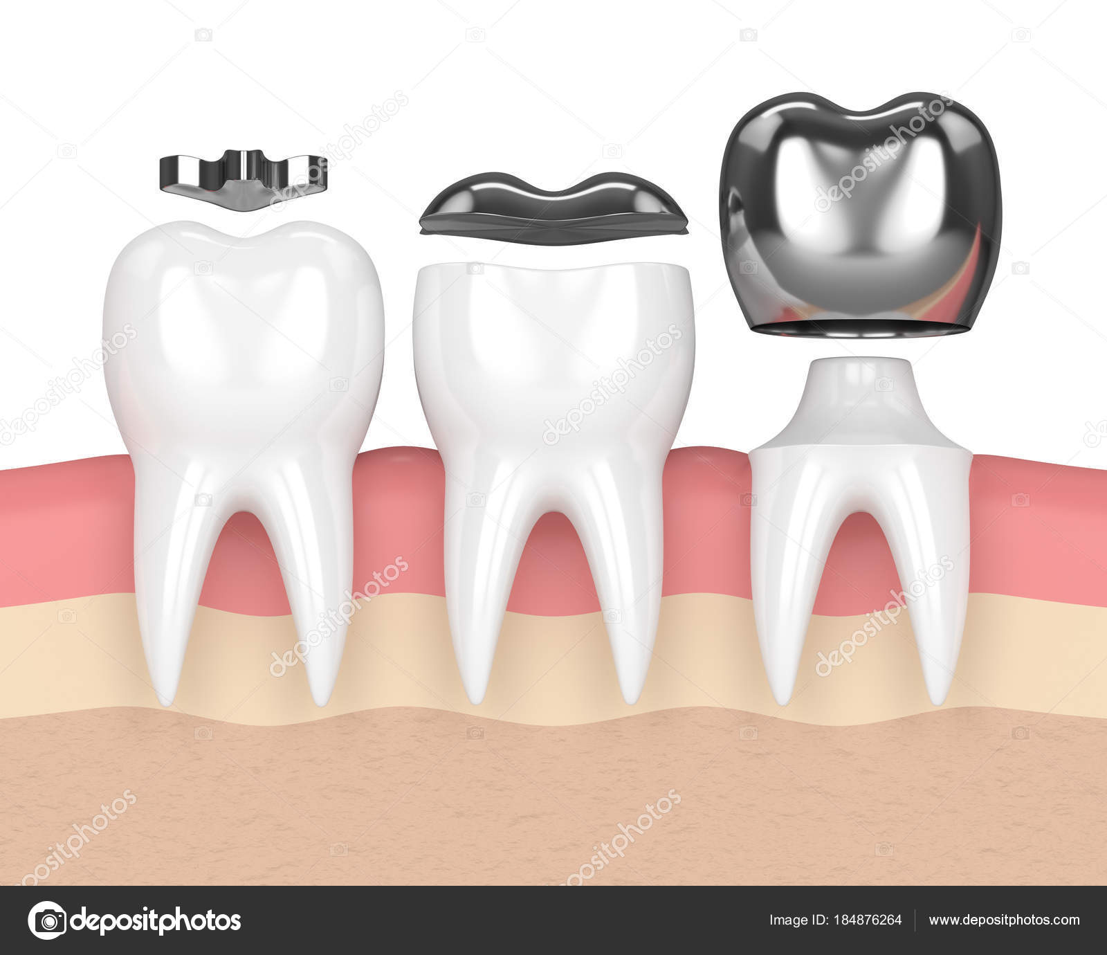3d render of teeth with different types of dental amalgam fillin ...