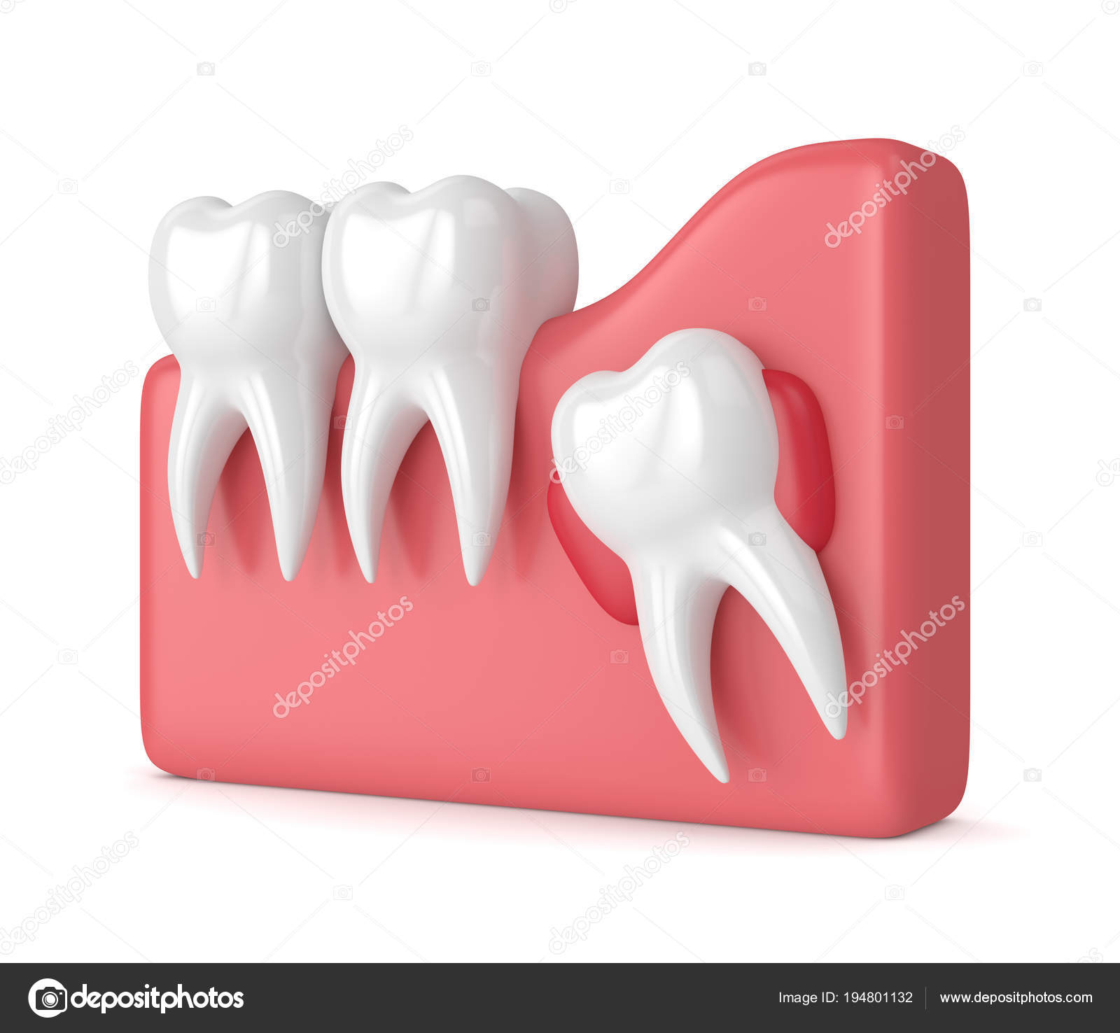 3d render of teeth with wisdom cyst — Stock Photo © ayo888 #194801132