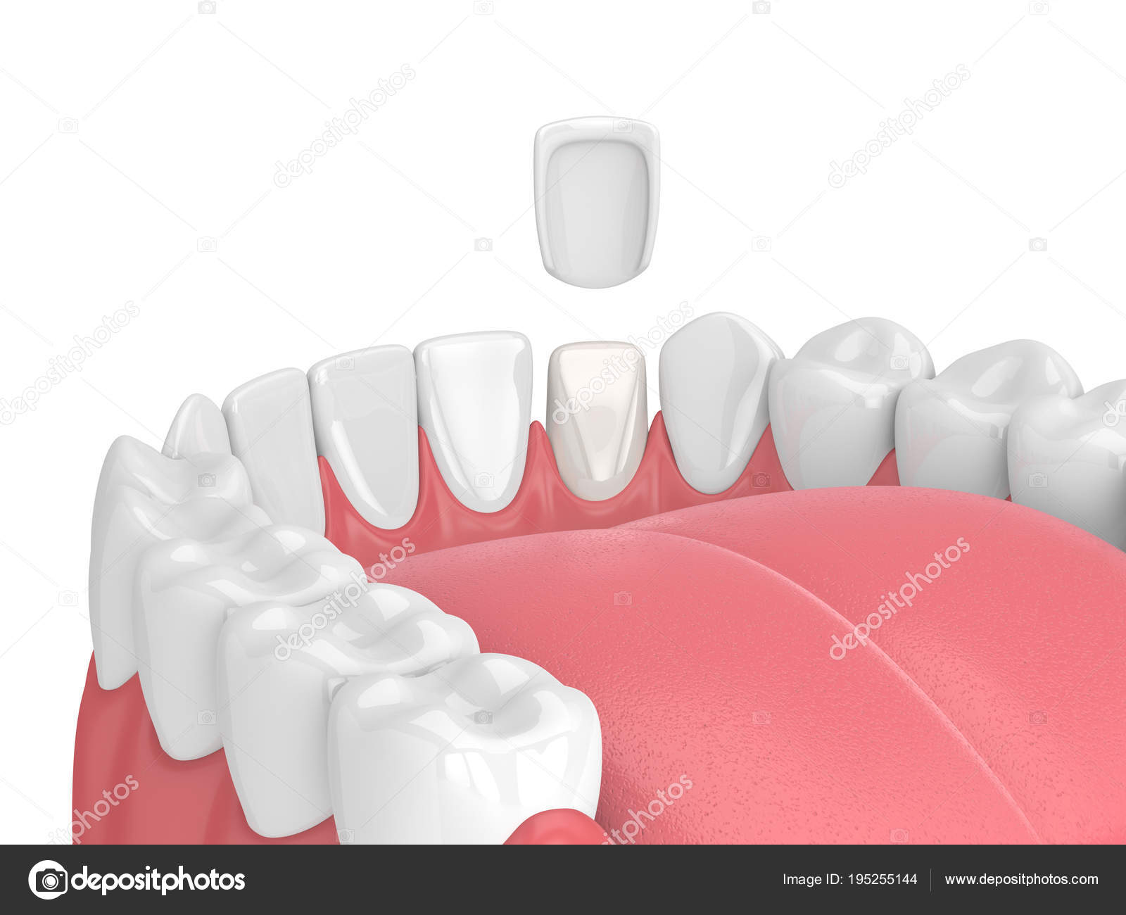 3d render of teeth with veneer — Stock Photo © ayo888 #195255144