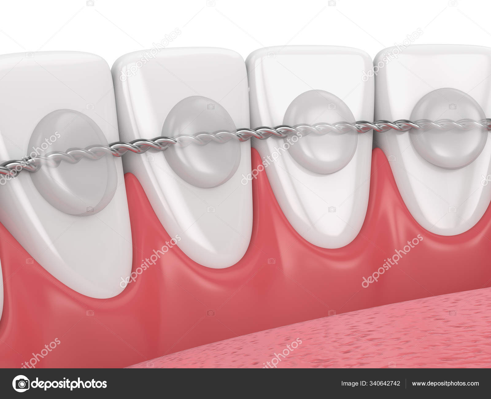 3d render of dental bonded retainer on lower jaw — Stock Photo © ayo888 ...