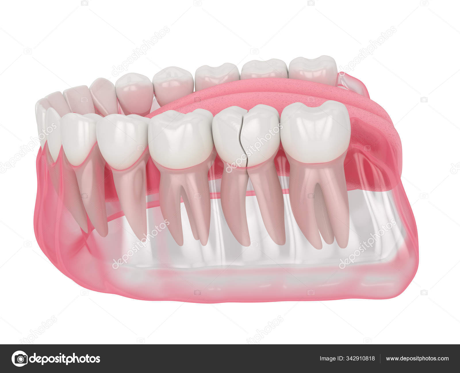 3d render of jaw with cracked tooth Stock Photo by ©ayo888 342910818