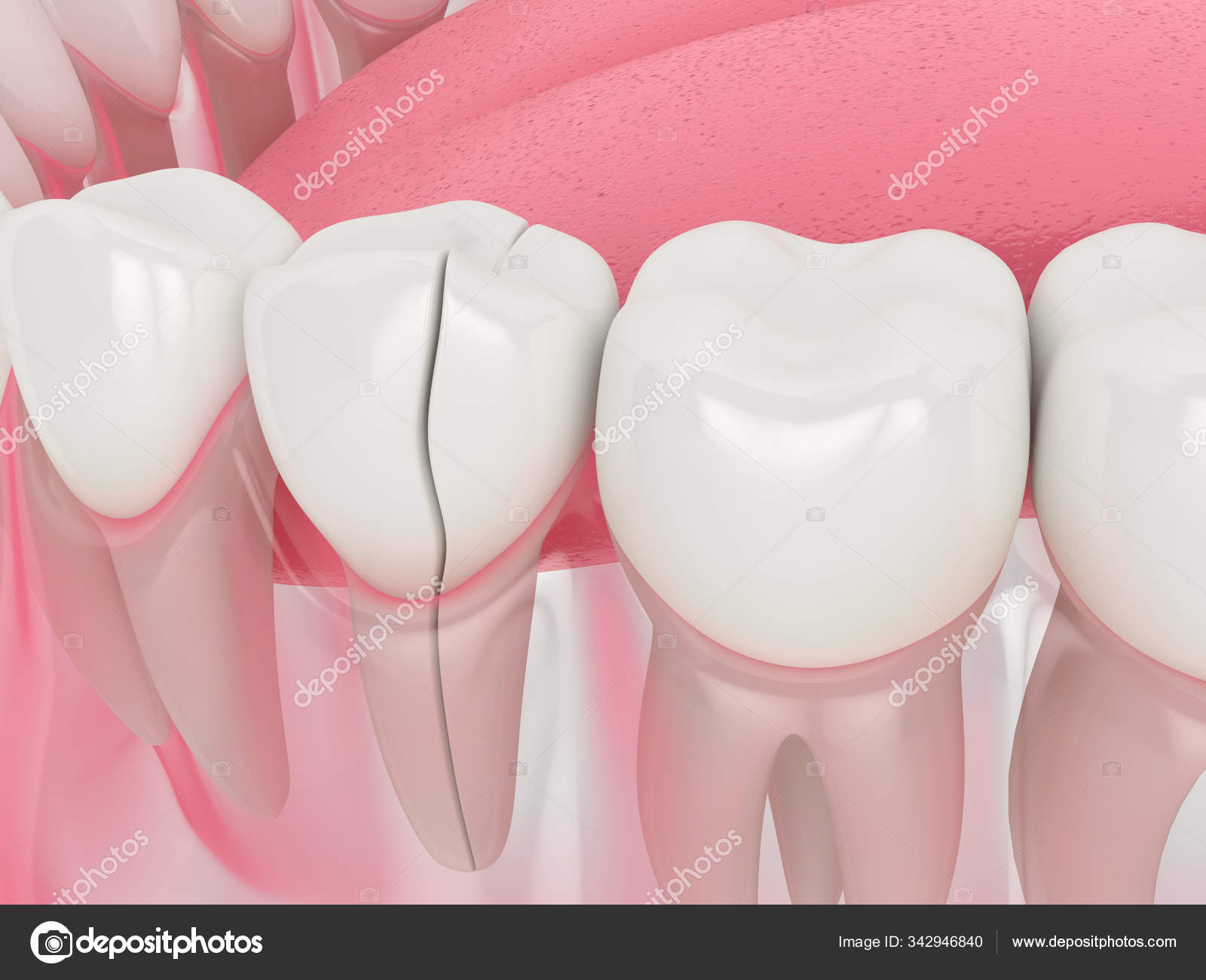 3d render of jaw with split tooth — Stock Photo © ayo888 #342946840