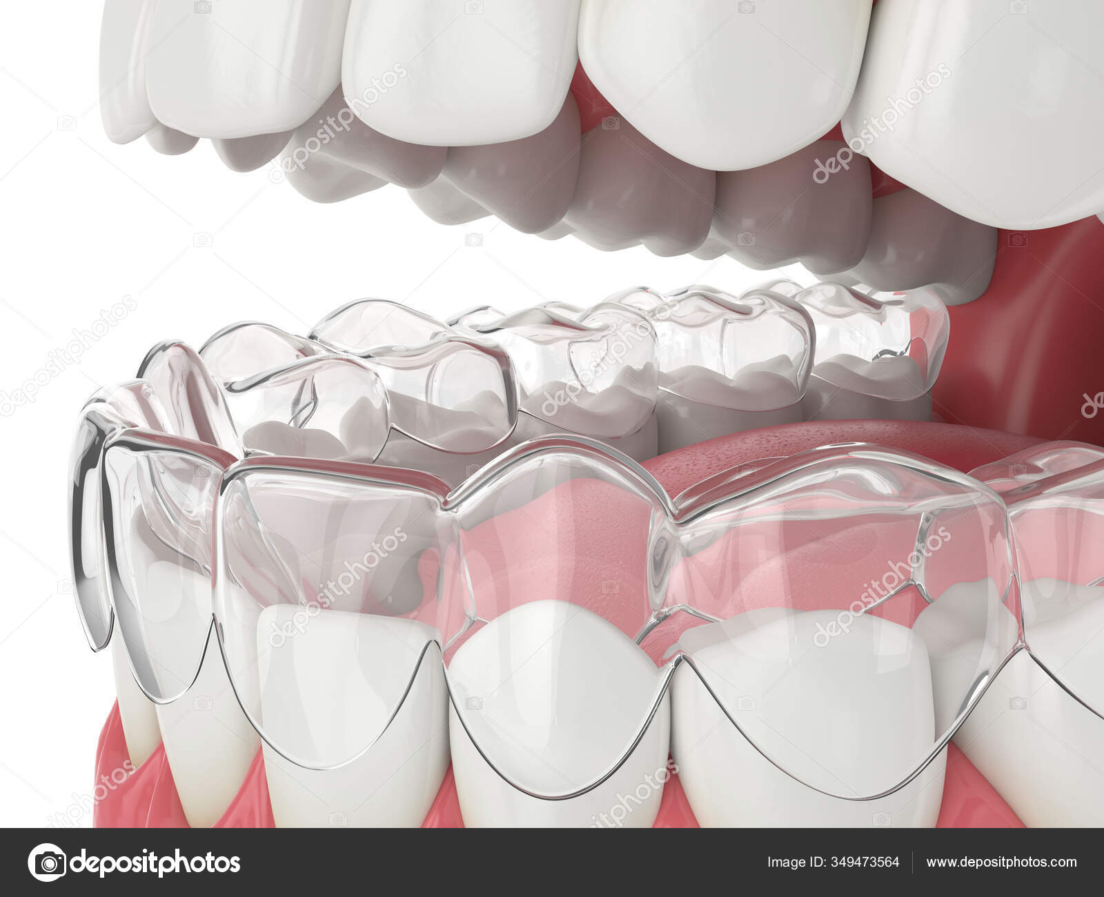 Render Jaw Invisalign Removable Retainer White Background Stock Photo ...