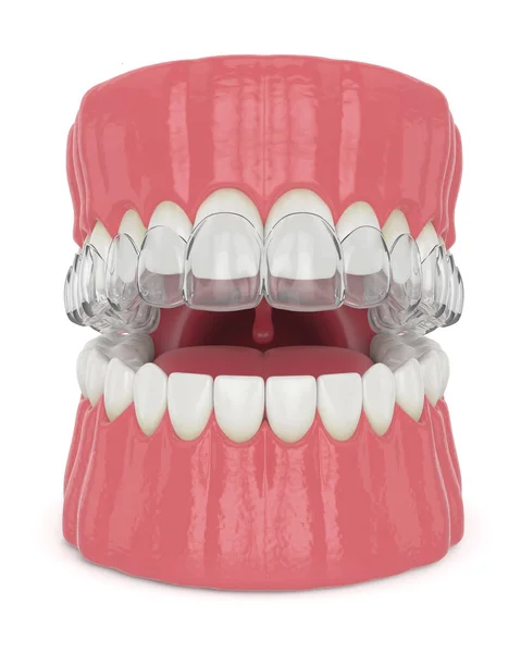 Render Invisalign Removable Invisible Retainer Lower Jaw White ...