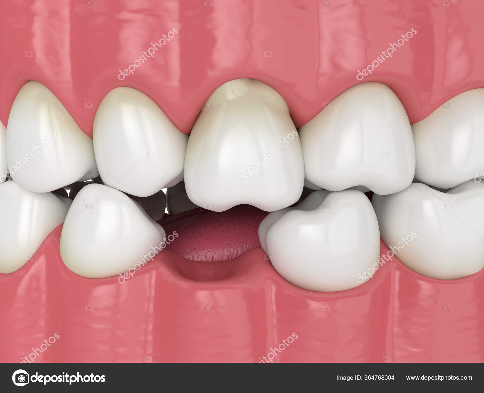 Tooth Pulp Cavity Slide