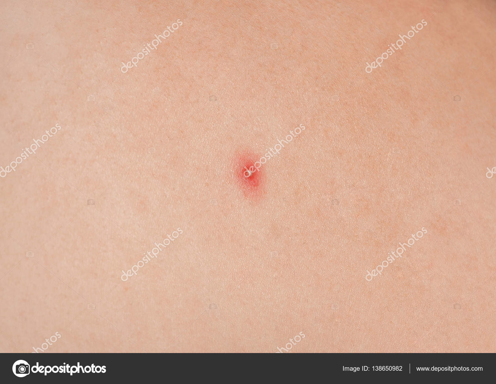 Grandes pústulas rojas en la piel de cerca. Belleza y cuidado de la ...