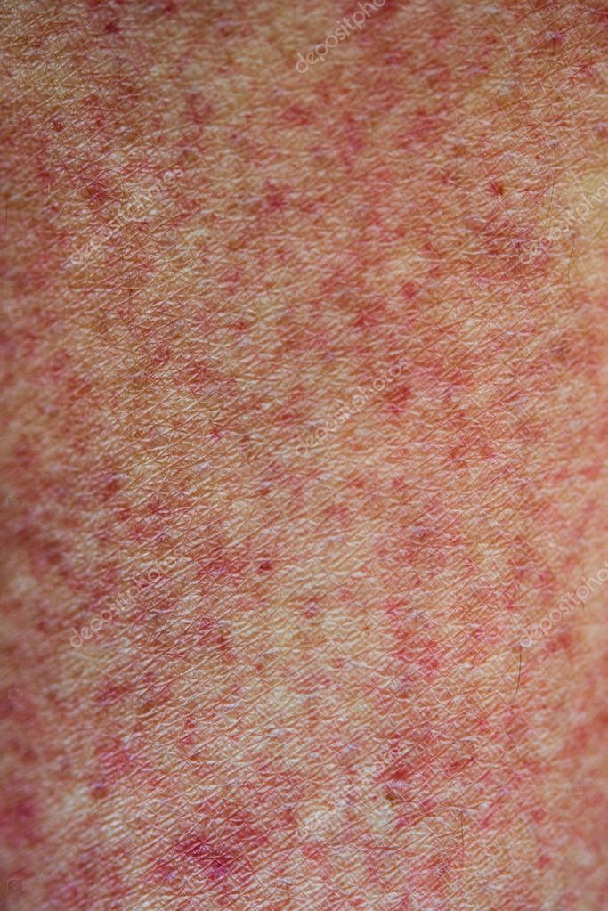 Skin with red rashes — Stock Photo © szefei #174477834