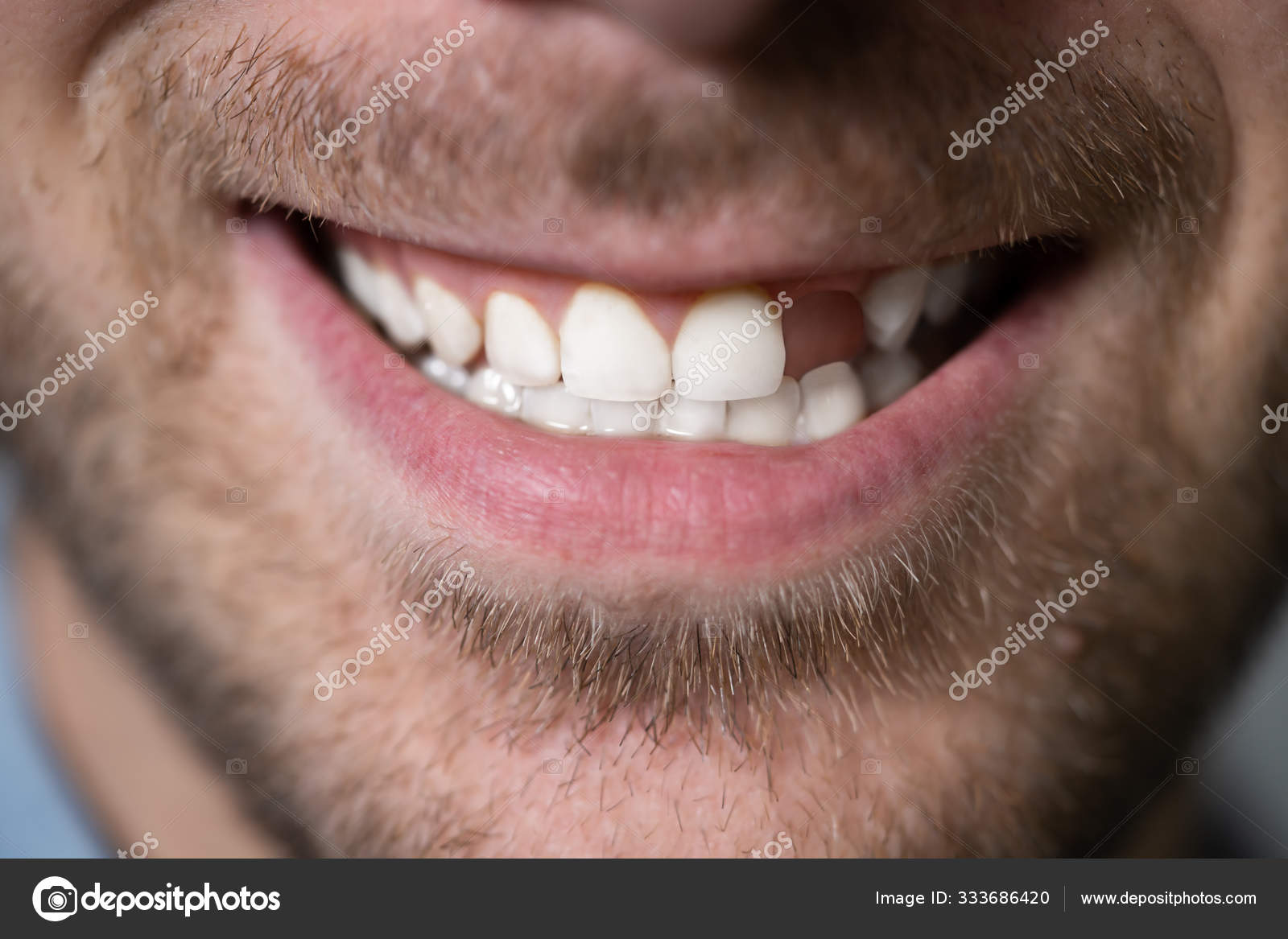 Close Photo Young Man Missing Tooth — Stock Photo © AndreyPopov #333686420