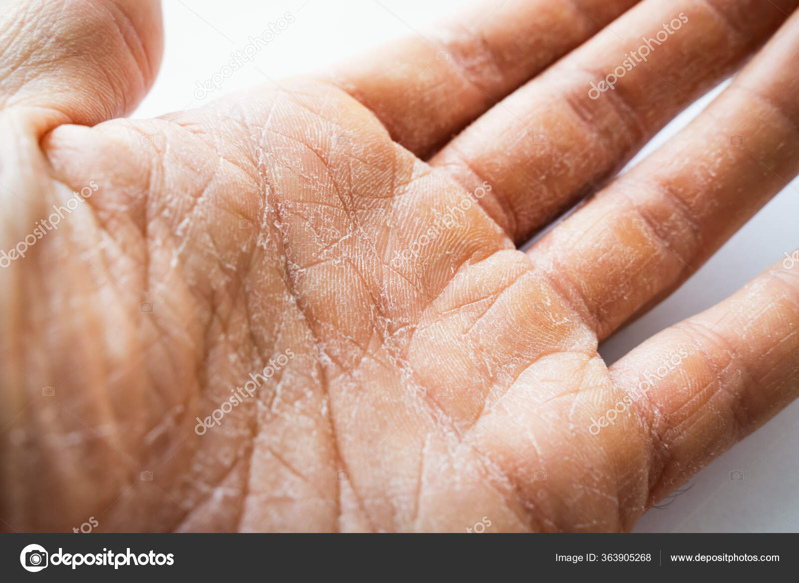 Peeling Skin On Palms