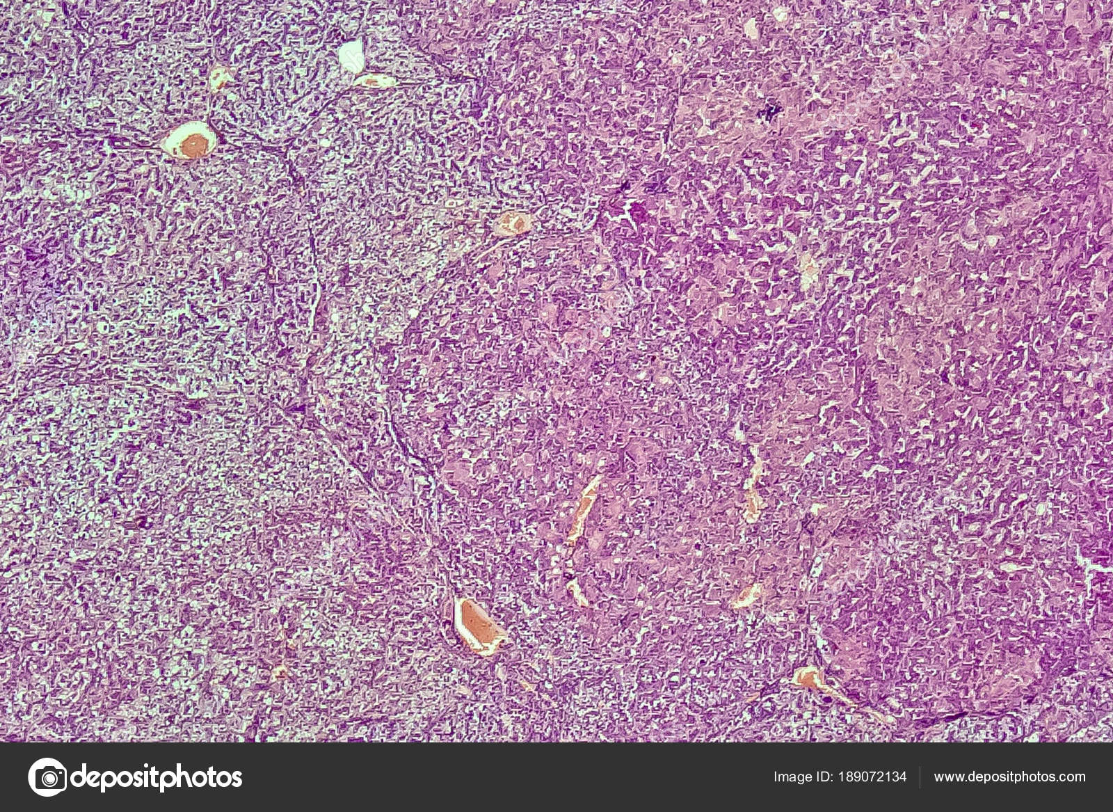 Hépatique Sous Microscope Cirrhose – AFEF