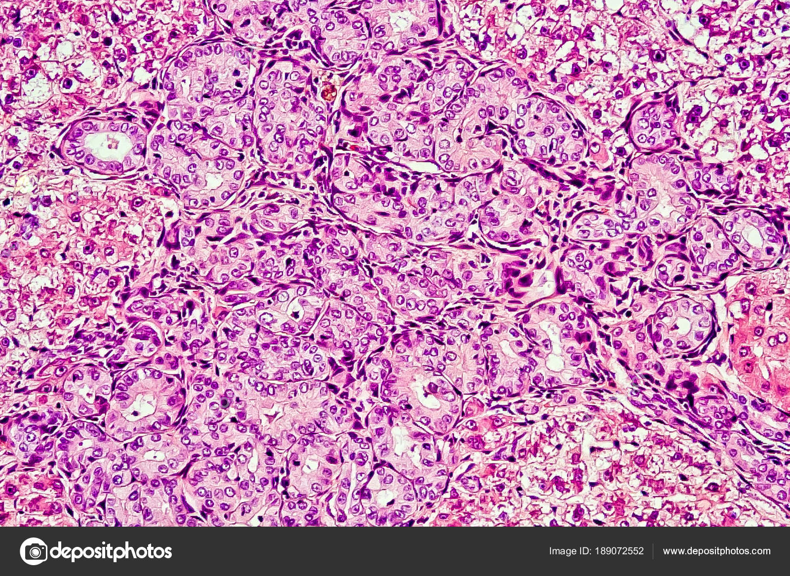 Hepatocellular Carcinoma Histology