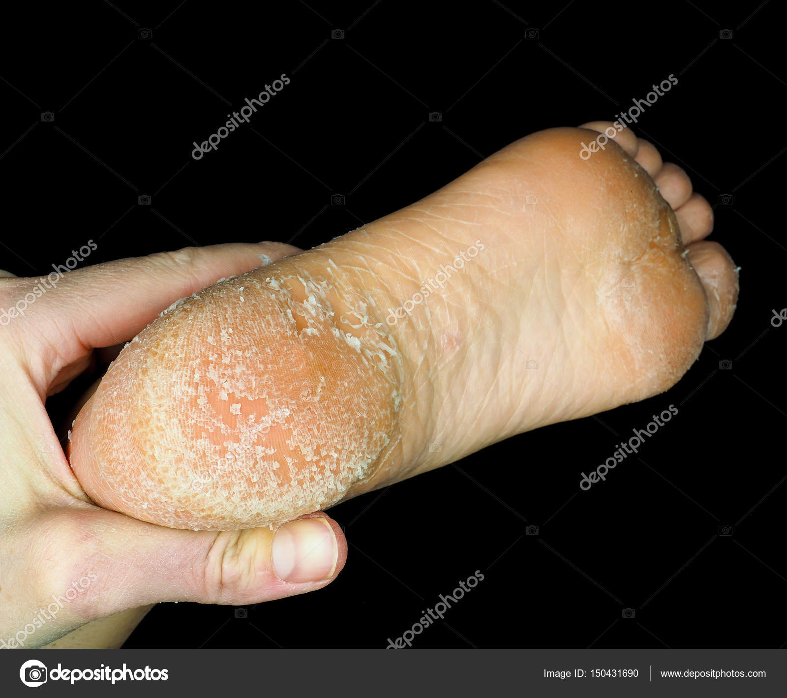 Skin peel on left foot of a caucasian person at a podiatrist Stock ...