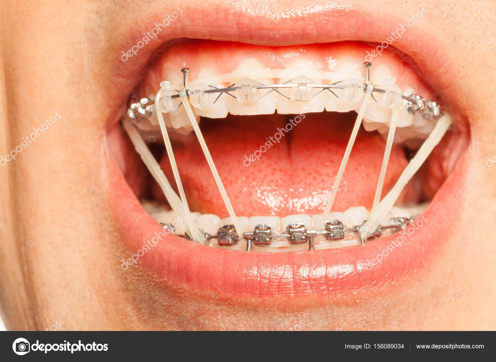 Man with orthodontic rubber ring Stock Photo by ©serrnovik 156089034