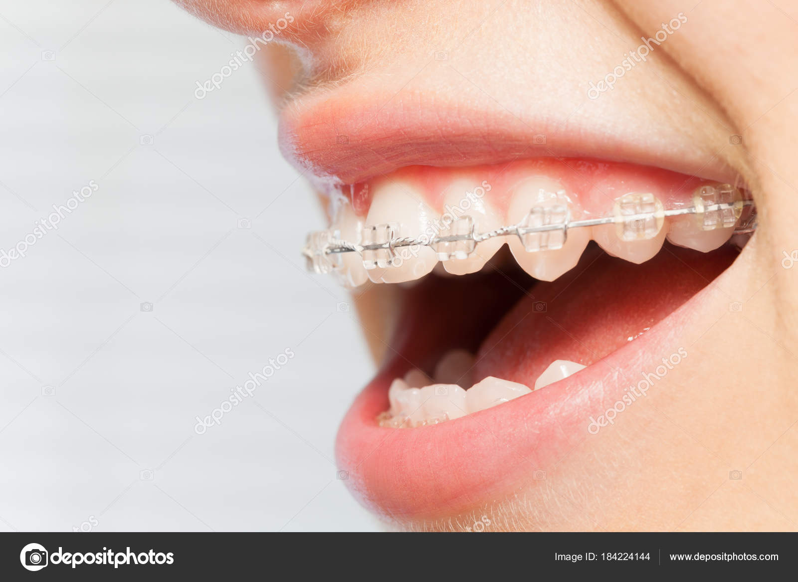 Side View Picture Womans Smile Dental Braces White Stock Photo by ...
