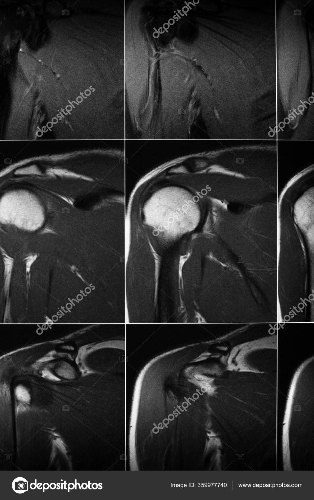 Mri Shoulder History Rotator Cuff Tear Suspected Lipoma Left Shoulder ...