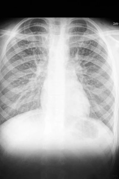 Radiograph of human chest Stock Photos, Royalty Free Radiograph of ...