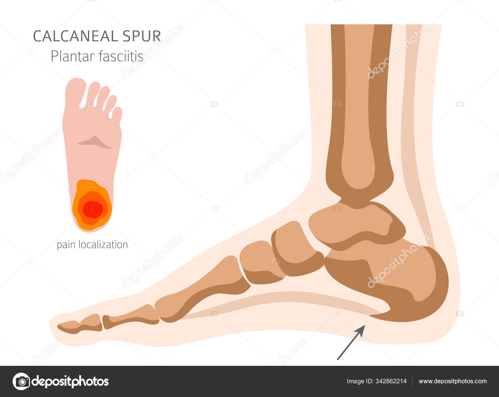 Calcaneal spur. Plantar fasciitis set. Medical desease infograph Stock ...