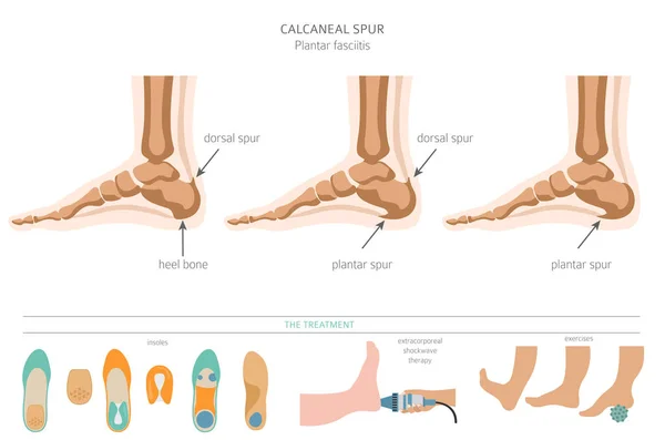 Retrocalcaneal Spur