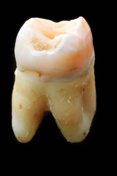 Abscess tooth Stock Photos, Royalty Free Abscess tooth Images ...