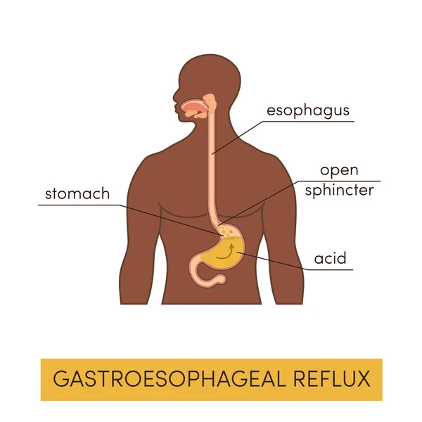 200 Acid reflux diagram Vector Images, Acid reflux diagram ...