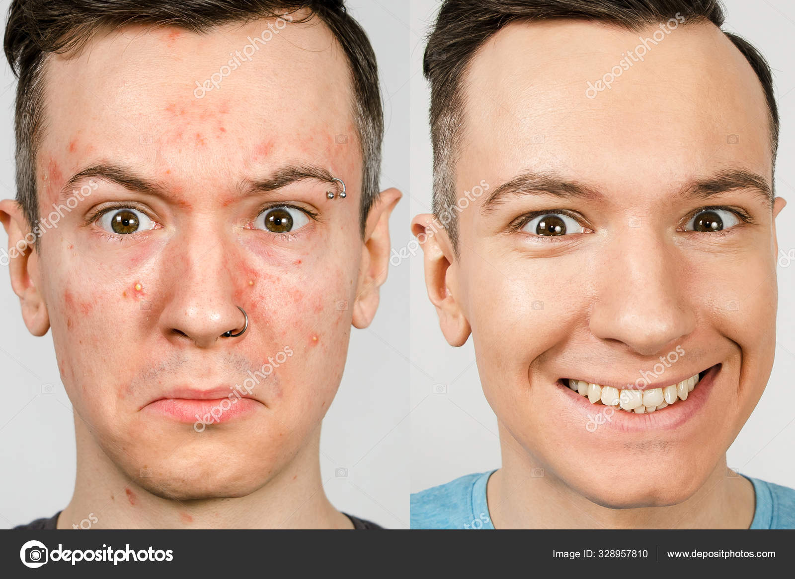Pimples On Face Men