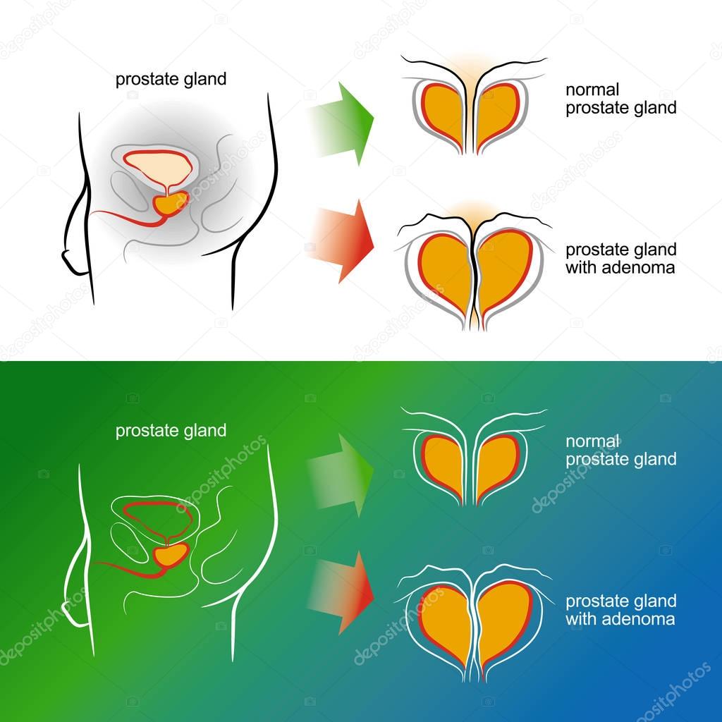 Esbozo de una glándula prostática masculina con adenoma. Ilustración ...