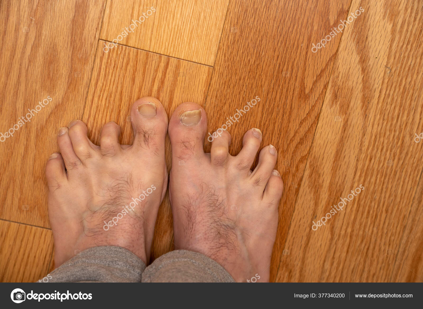 Dislocated Second Toe Surgery