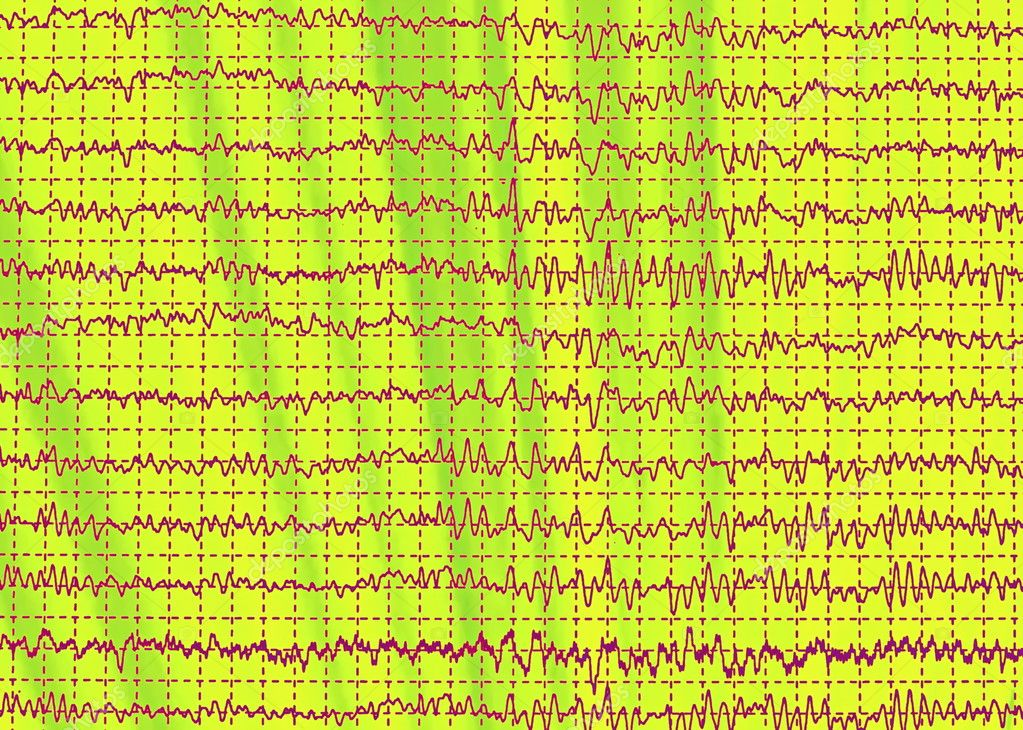 Brain wave on electroencephalogram EEG for epilepsy Stock Photo by ...