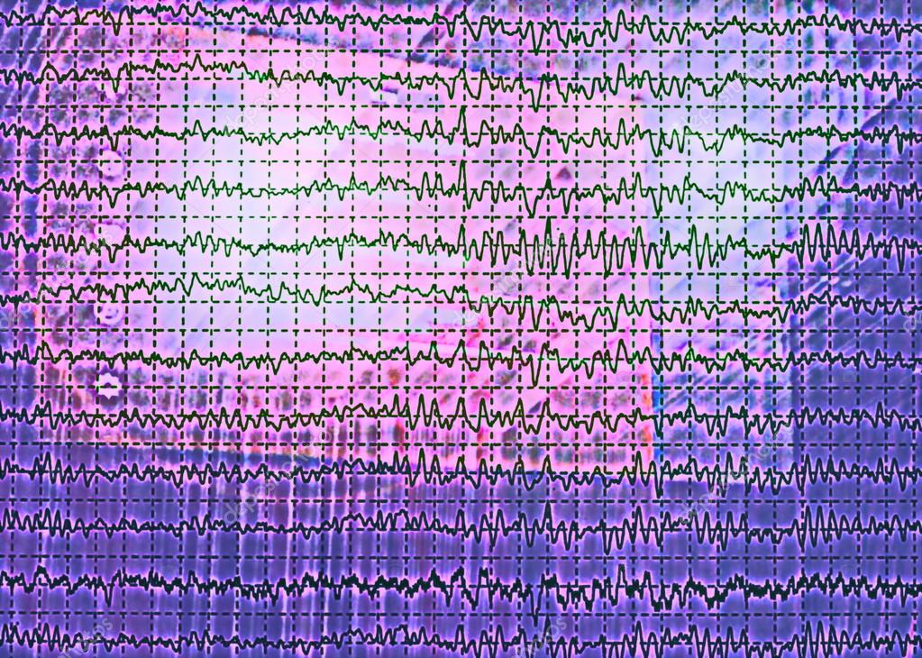 Electroencephalogram Eeg Uses Procedure Results