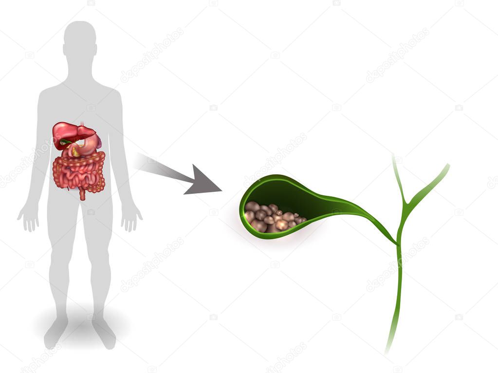 Cálculos biliares en la vesícula biliar, anatomía brillante ilustración ...