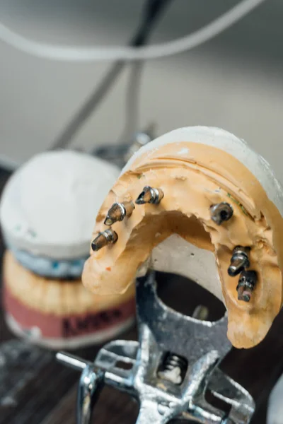 Set Sample Individual Plaster Jaws Close Dental Dentistry Process ...