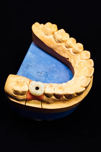 Set Sample Individual Plaster Jaws Close Dental Dentistry Process ...