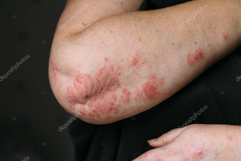 Psoriasis en el codo. Foto de primer plano de piel seca escamosa con ...