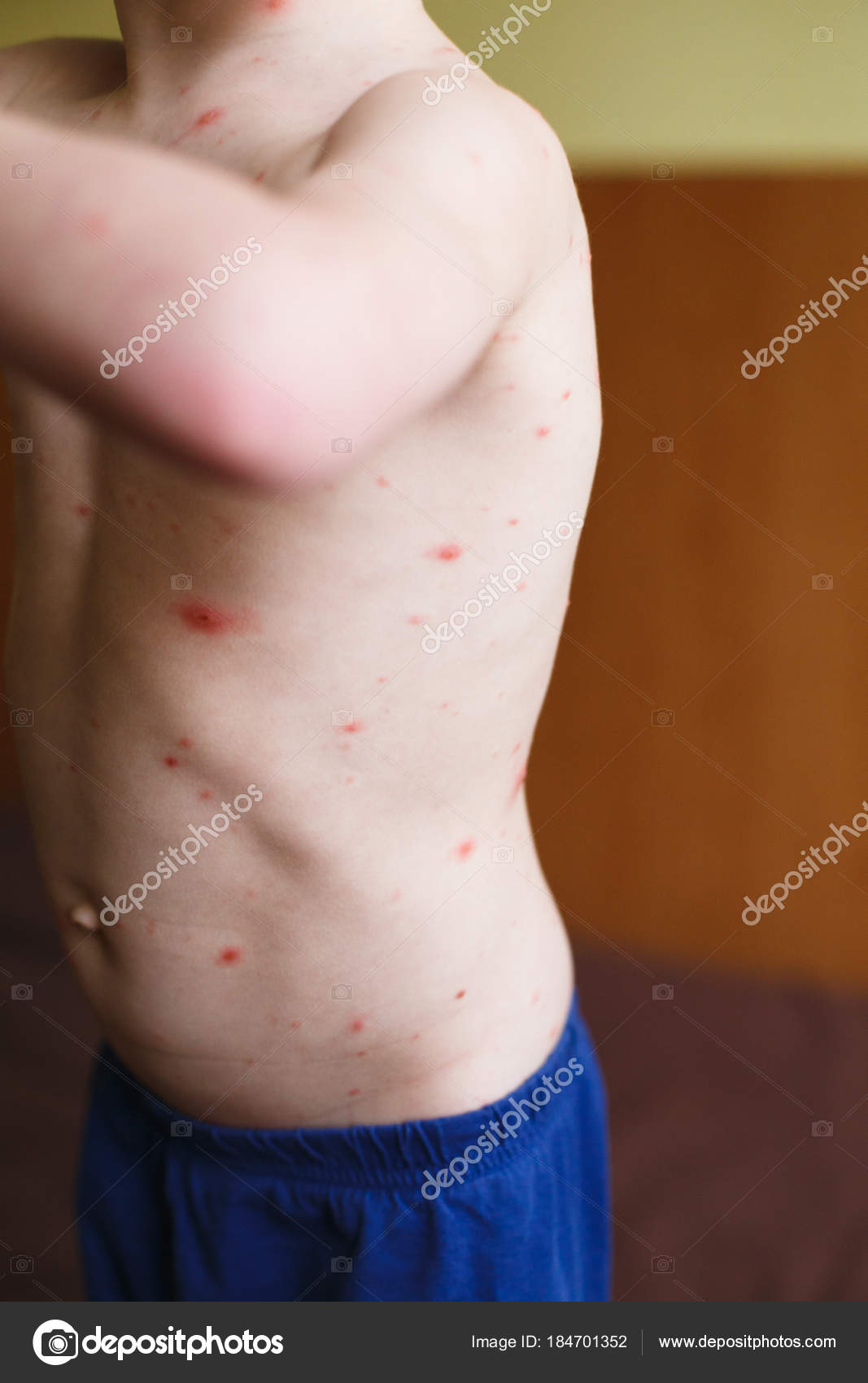 Baby with chicken pox rash. Varicella virus or Chickenpox bubble rash ...
