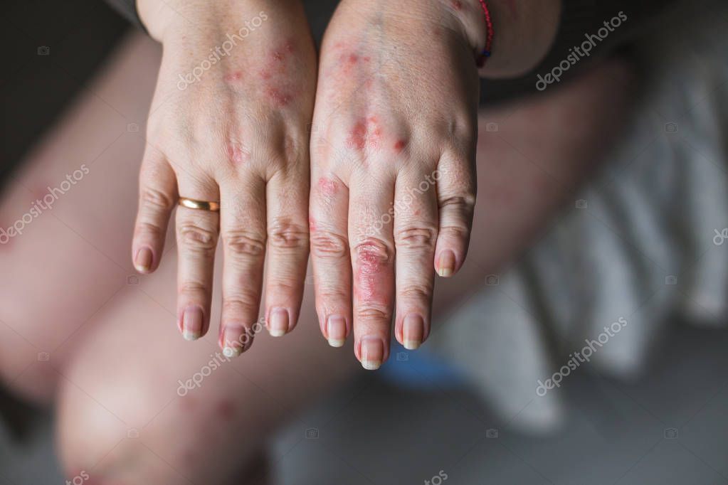 Psoriasis vulgar en las manos de las mujeres con placa, erupción ...