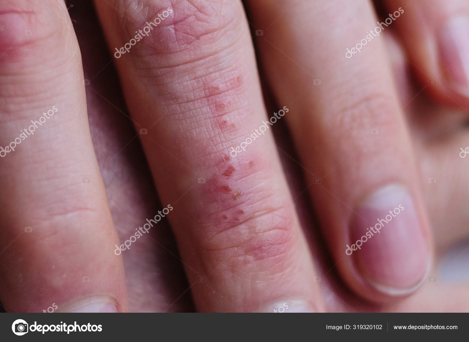 Peau de psoriasis. Le psoriasis est une maladie auto-immune qui affecte ...