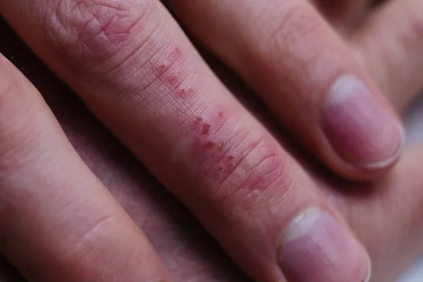 Fotos de Psoriasis manos, Imágenes de Psoriasis manos ⬇ Descargar ...