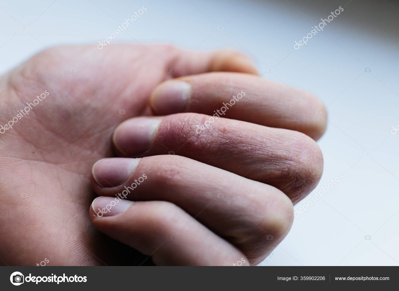 Hombre con manos enfermas, piel seca y escamosa en la mano con ...