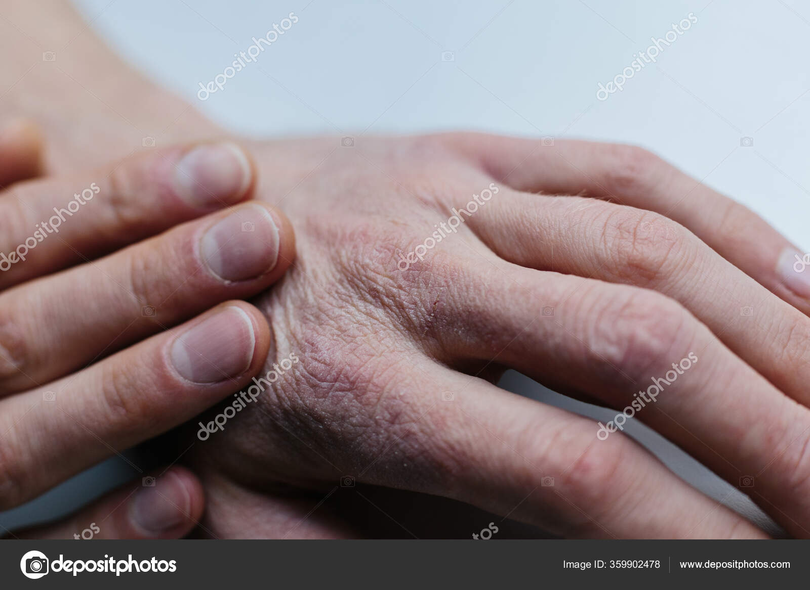 Hombre con manos enfermas, piel seca y escamosa en la mano con ...