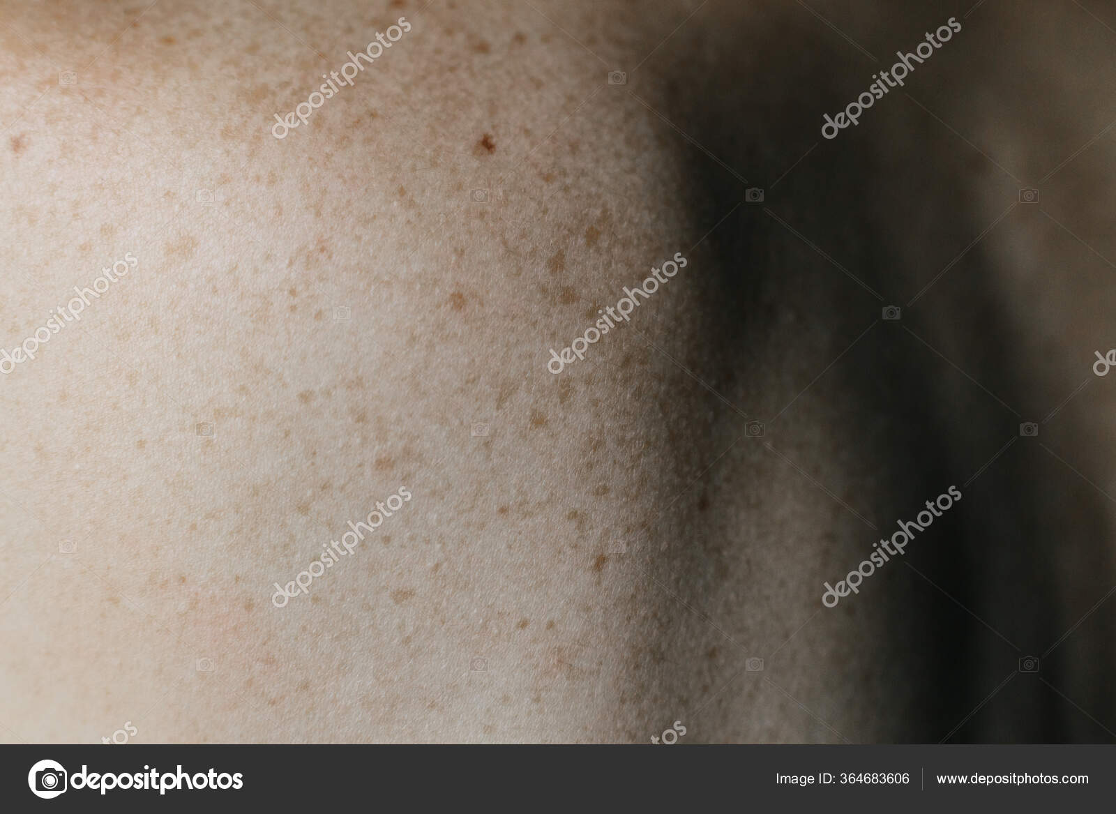 Checking Benign Moles Close Detail Bare Skin Man Back Scattered — Stock ...