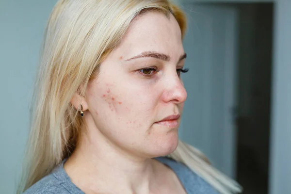 Melasma na pele Stock Photos, Royalty Free Melasma na pele Images ...