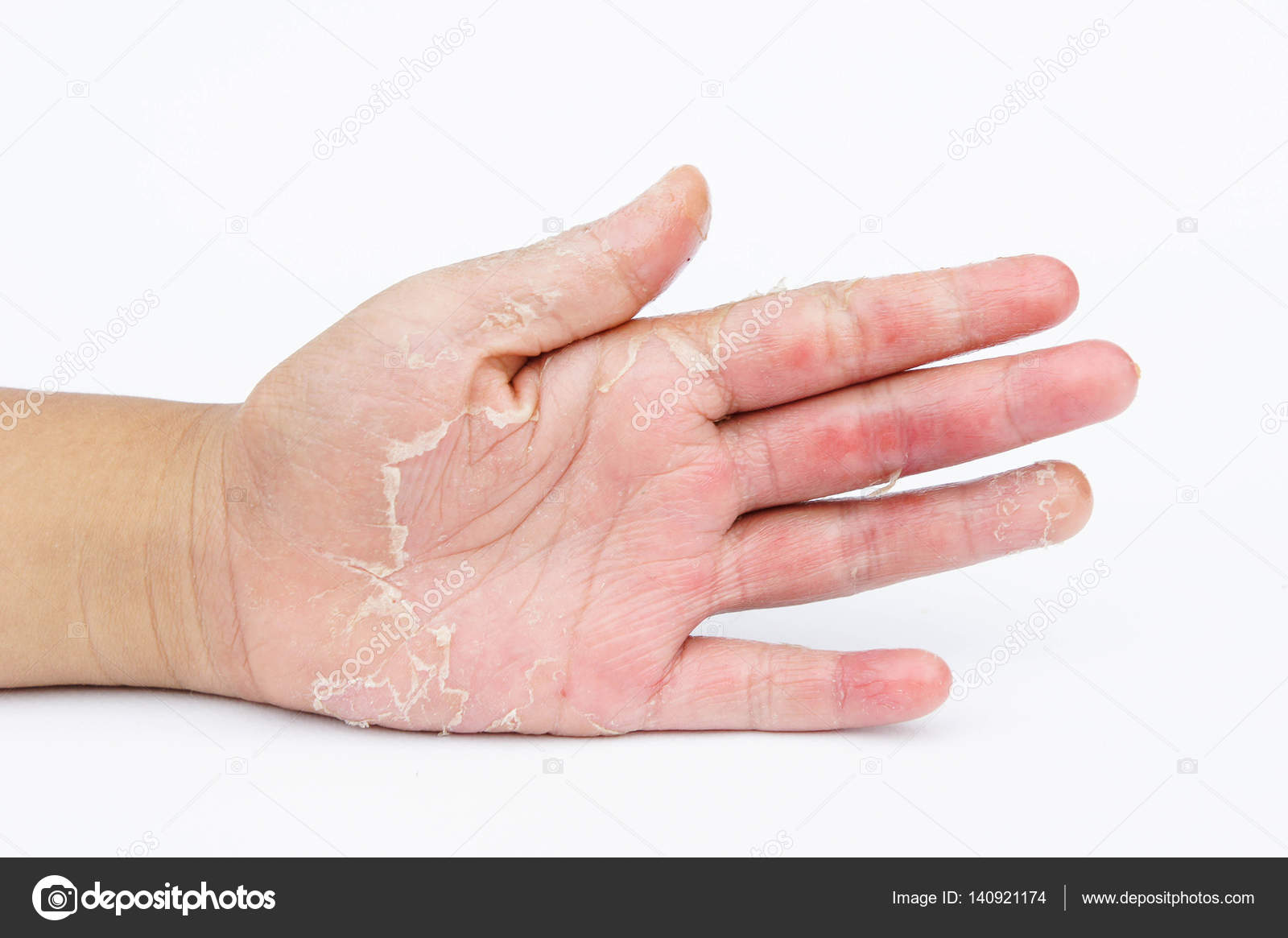 Dry Skin Fungus On Hands at Justin Goodenough blog