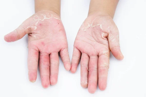 Dry hands, peel, Contact dermatitis, fungal infections Stock Photo by ...